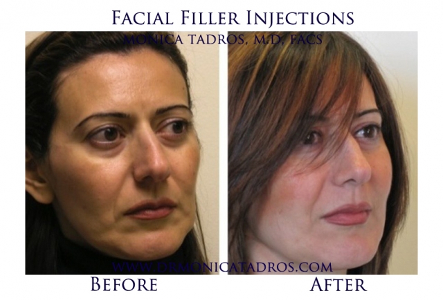 Facial Filler Injections Before & After - A | Dr. Monica Tadros