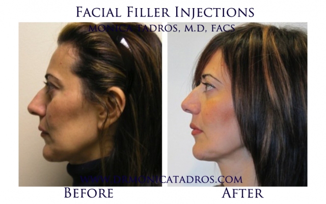 Facial Filler Injections Before & After - A | Dr. Monica Tadros